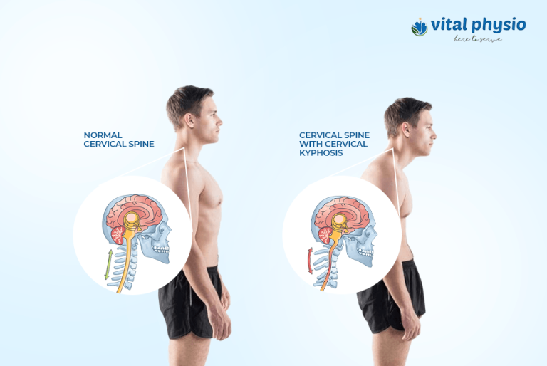 Exercises to Relieve Cervical Kyphosis Pain